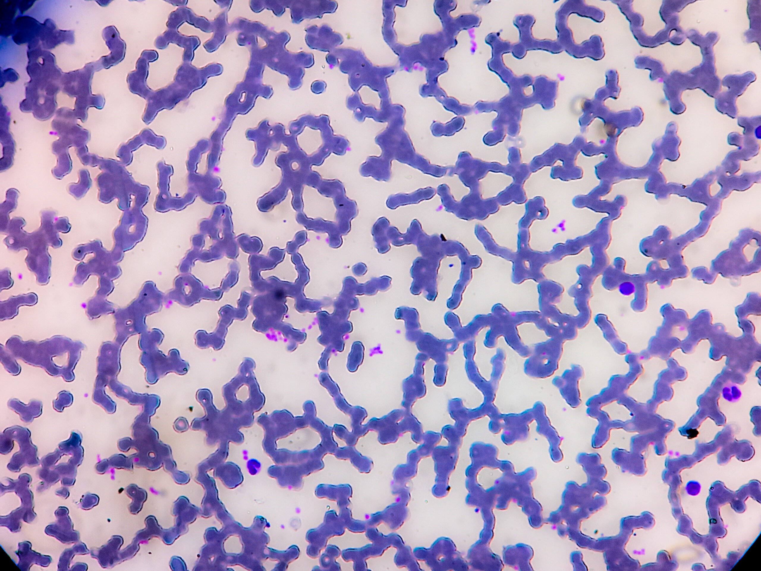 AMPLIFY Study: Upfront Acalabrutinib-Based Combo Effective in High-Risk ...