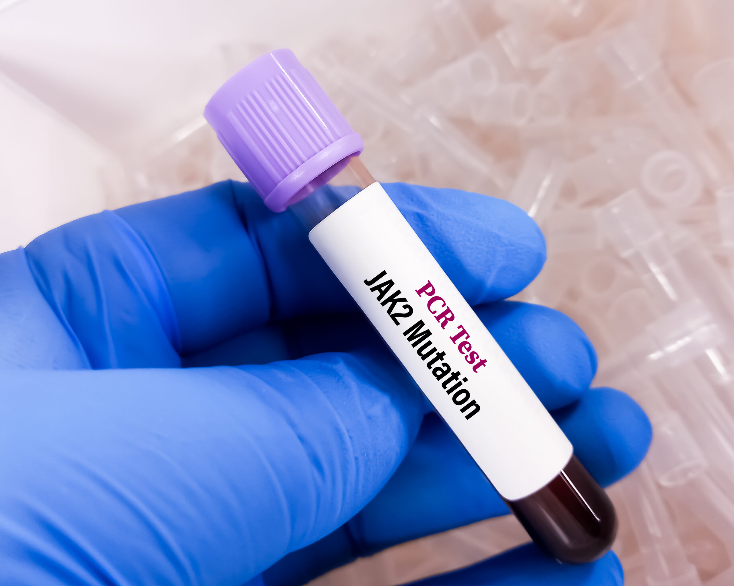Real-World Study Points to Need to Individualize MF Treatment | Blood ...
