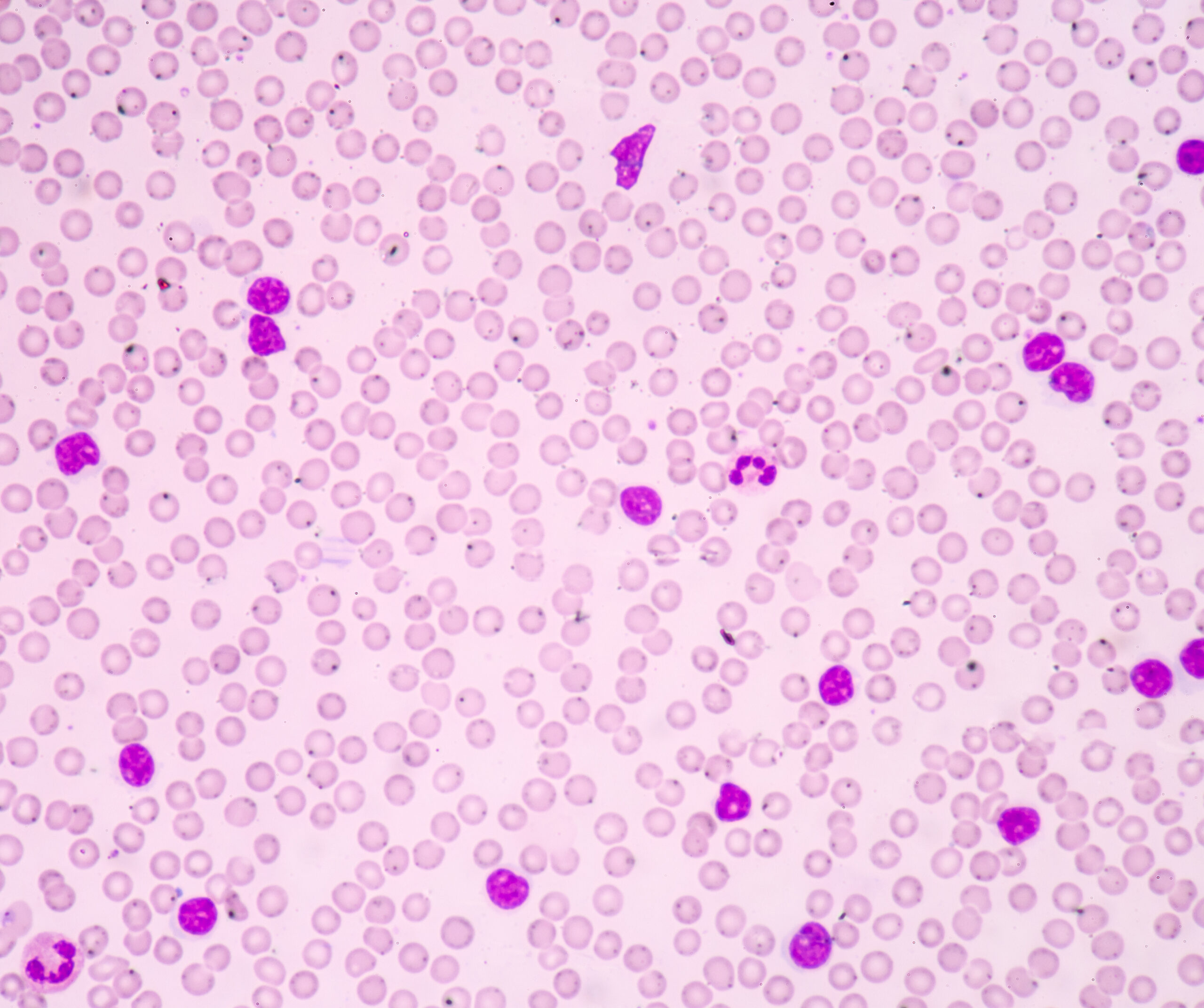 STAIR Trial Tests the Limits of Stopping Acalabrutinib in Frail, Older ...