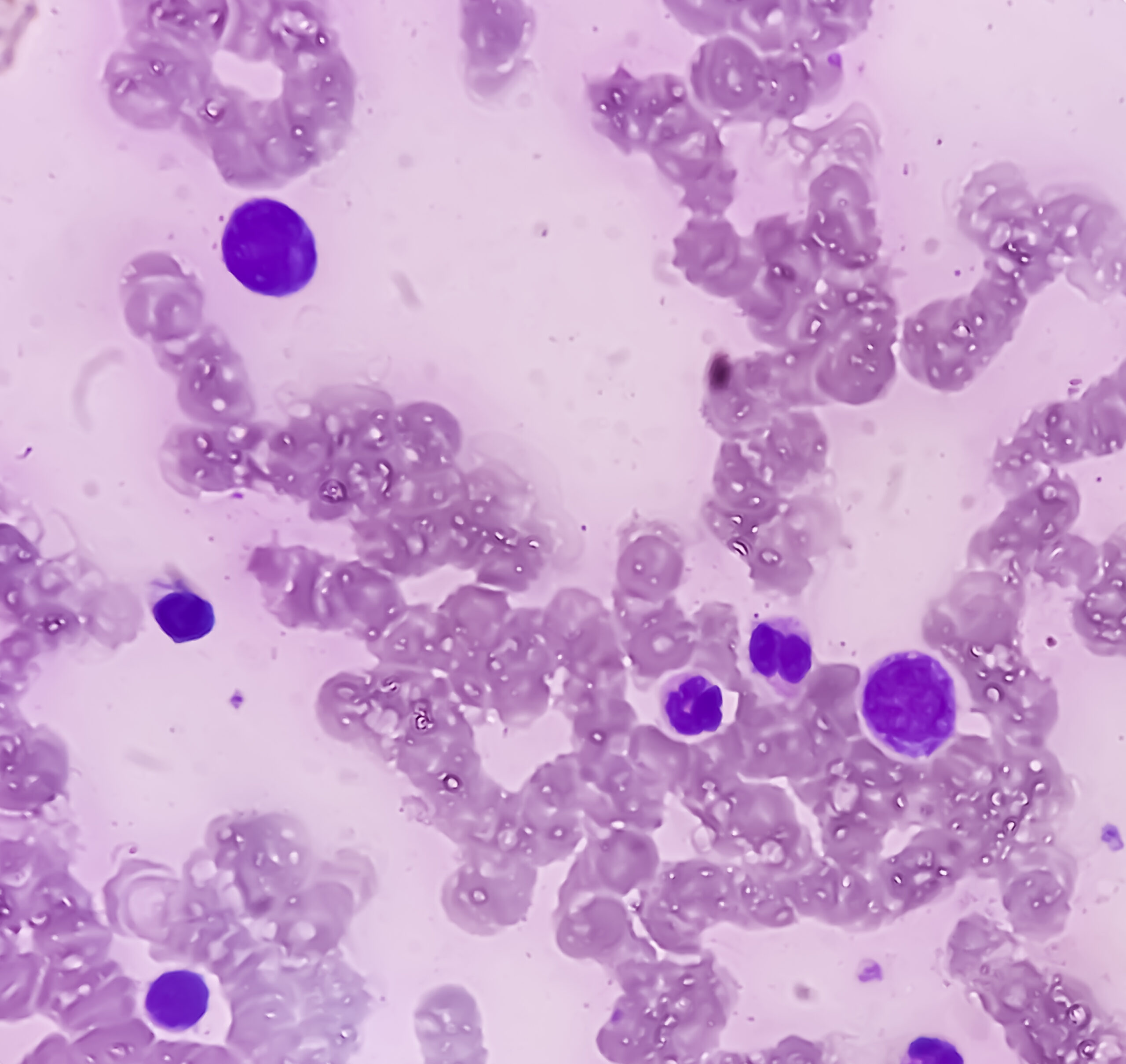 Real-World Data Show Cytopenic Myelofibrosis May Signal Poor Prognosis ...