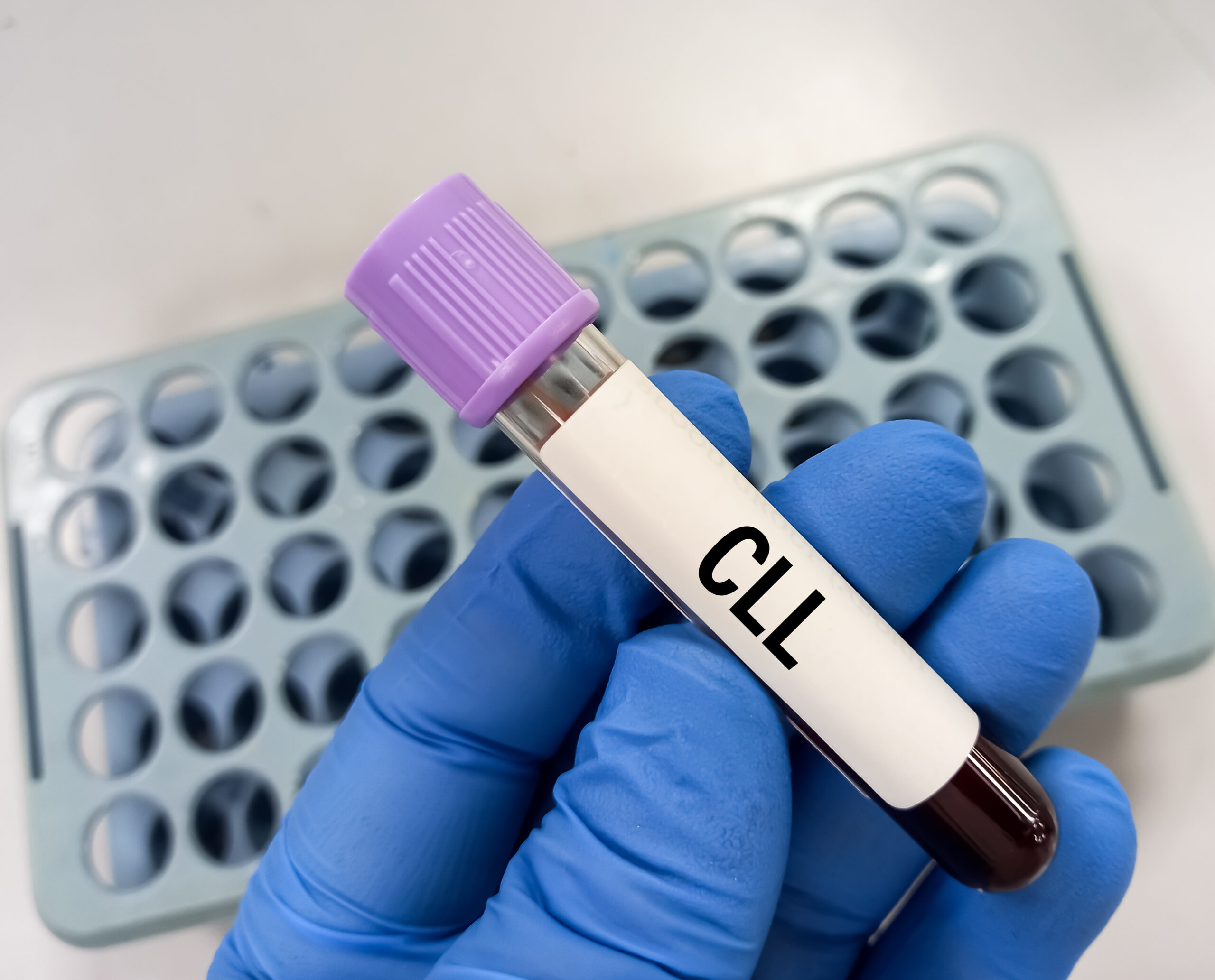 Safety Profile of Zanubrutinib Versus Venetoclax-Obinutuzumab in ...