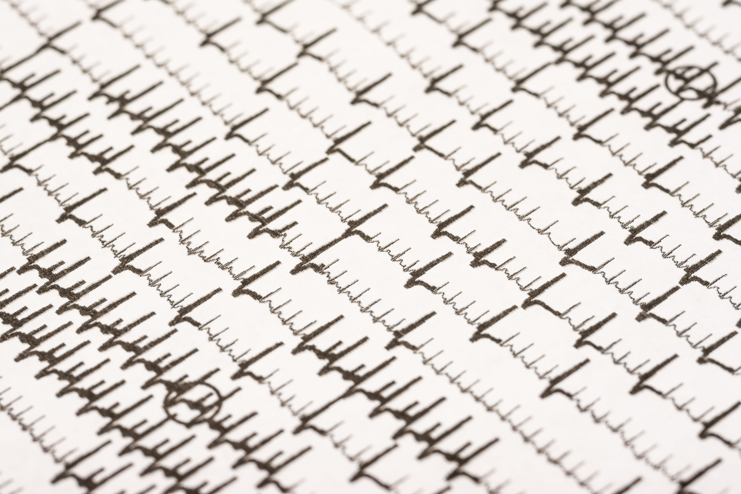 Novel Scale for Atrial Fibrillation Prediction in Patients with Stroke ...