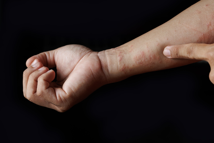 Moisturizing Cream with Ethanol May be Safe for People with Atopic ...