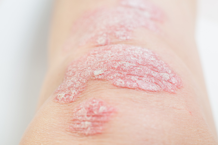 Icotrokinra Improves Overall Skin and High-Impact Site Clearance in ...