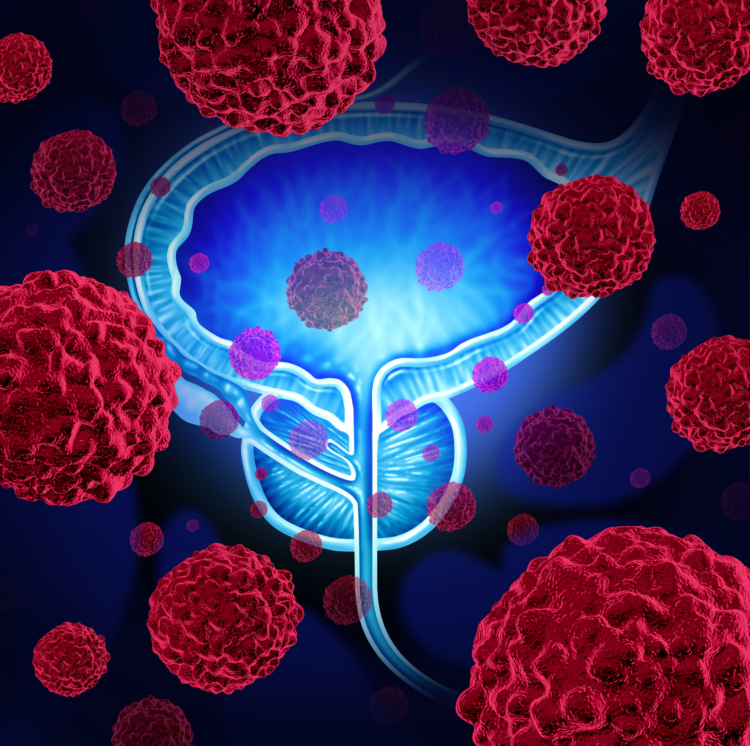 PFS Endpoints May Be OS Surrogates For Metastatic HSPC GU Oncology Now