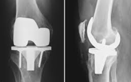 Uncemented Knee Replacements Show Promise for Severely Obese Patients ...