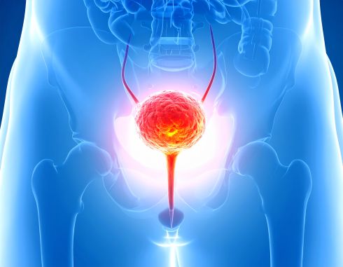 Postoperative Radiation Reduces Pelvic Recurrence in High-Risk Bladder ...